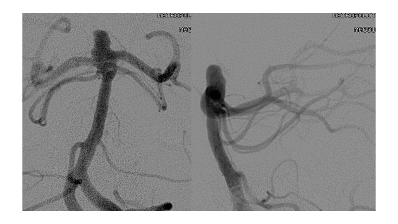 Εμβολισμός ανευρύσματος βασικής αρτηρίας με Y-stenting